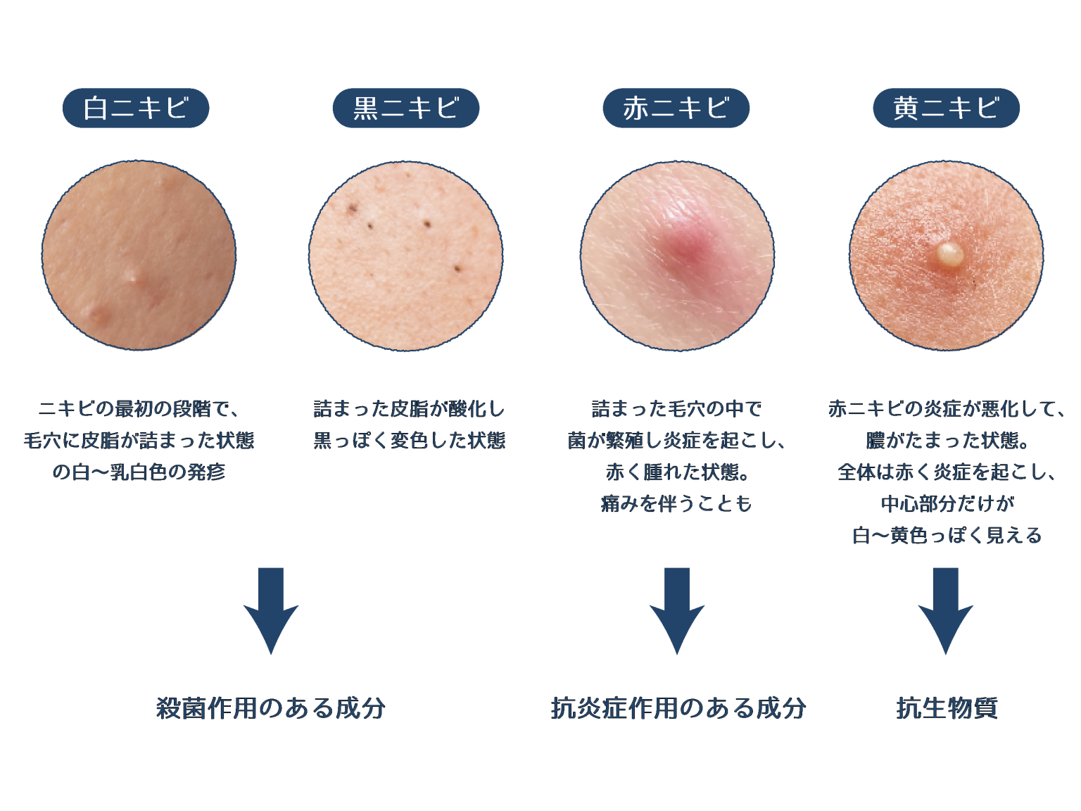 首ニキビの原因と治し方は？部位別の原因と効果的な治療薬を解説 | ハダメディア by BIHADADO.TOKYO